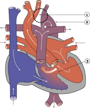 Interrupted Aortic Arch : 네이버 블로그