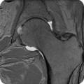 [영상의학] 무릎 MRI 판독법 : 네이버 블로그