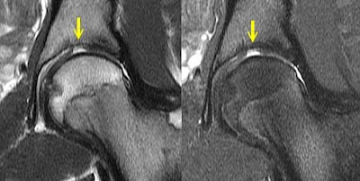 Stellate Crease and the Supraacetabular Fossa : 네이버 블로그