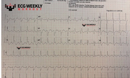 심전도, Left anterior fascicular block (LAFB)과 left posterior fascicular ...