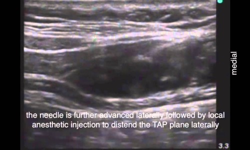 TAP block ultrasound guided transversus abdominis plane (TAP) block ...