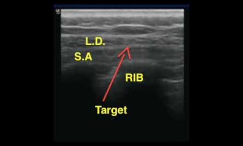 US guided PECS Block : 네이버 블로그
