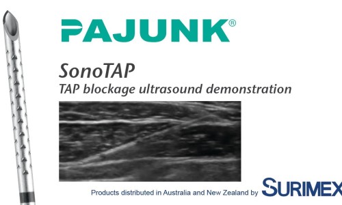 TAP block ultrasound guided transversus abdominis plane (TAP) block ...