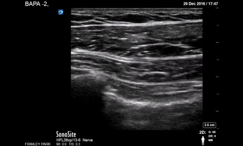 US guided PECS Block : 네이버 블로그
