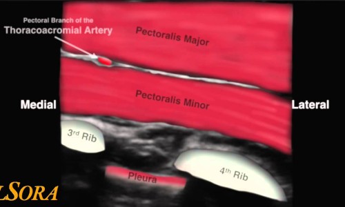 US guided PECS Block : 네이버 블로그