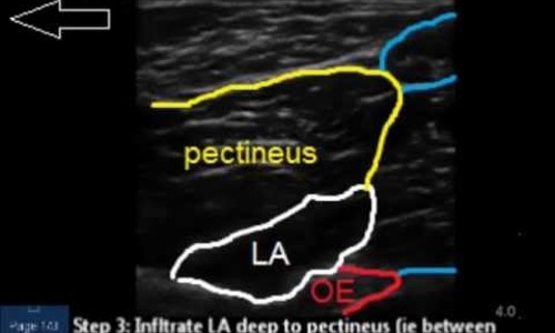 Hip Joint Anatomy and Obturator Nerve Block, Pectineous muscle : 네이버 블로그