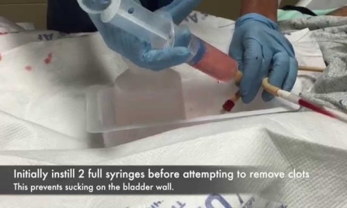 bladder irrigation / 간헐적 방광 세척, 지속적 방광 세척 : 네이버 블로그