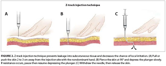 근육주사(IM) 부위별 최대용량(mL)과 절차 (Z-track) (+ 1 영상) : 네이버 블로그