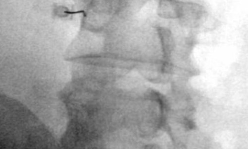 MBB, Medial Branch Block 내측지 신경차단술 vs SNRB, Selective Nerve Root Block ...
