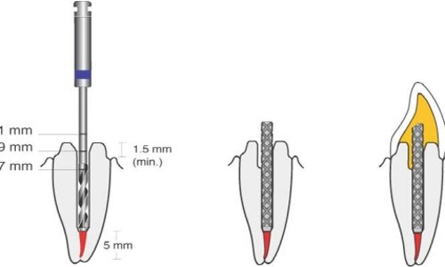 [정리] 치과 포스트(POST)-코어(CORE) 술식 알아보기 : 네이버 블로그