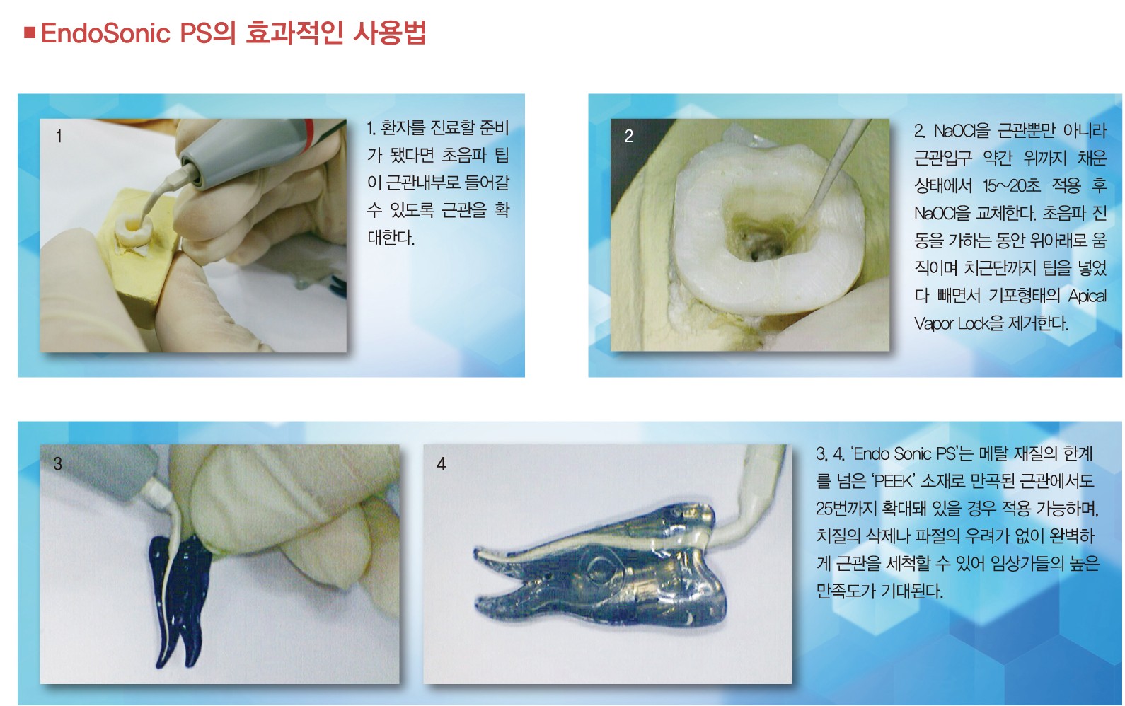 [쇼케이스] 셀렉트디, EndoSonic PS : 네이버 블로그