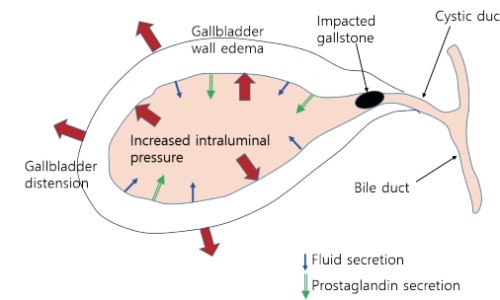 PTGBD, PTBD 차이, 간호 및 irrigation : 네이버 블로그